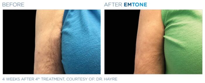 Emtone® Skin Tightening & Cellulite Treatment for Los Gatos & Campbell ...