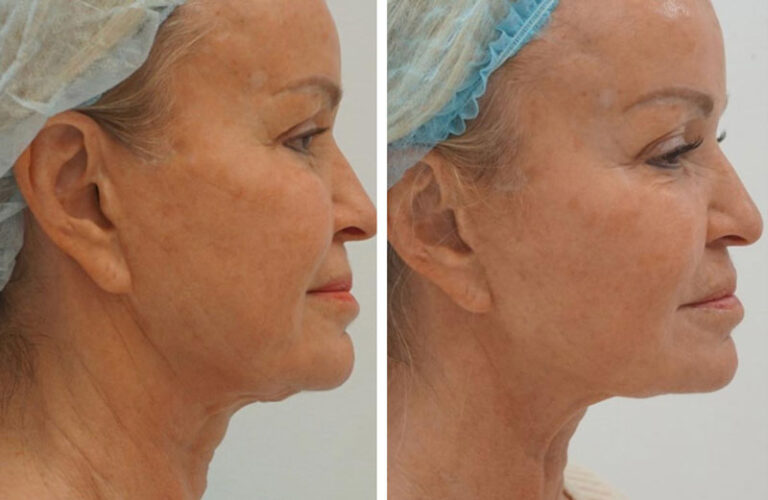 Sofwave™ Skin Tightening for Los Gatos & Campbell, CA - RefinedMD