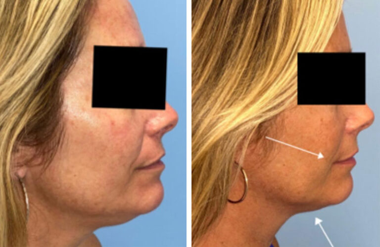 Sofwave™ Skin Tightening for Los Gatos & Campbell, CA - RefinedMD