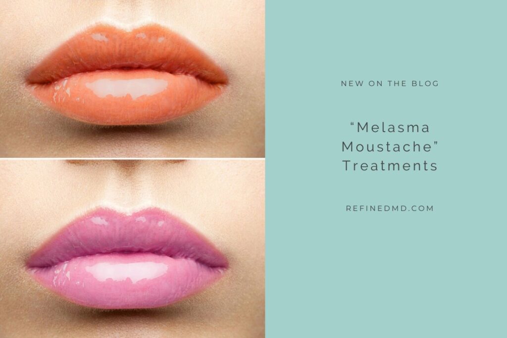 “Melasma Moustache” Treatments | RefinedMD, Los Gatos