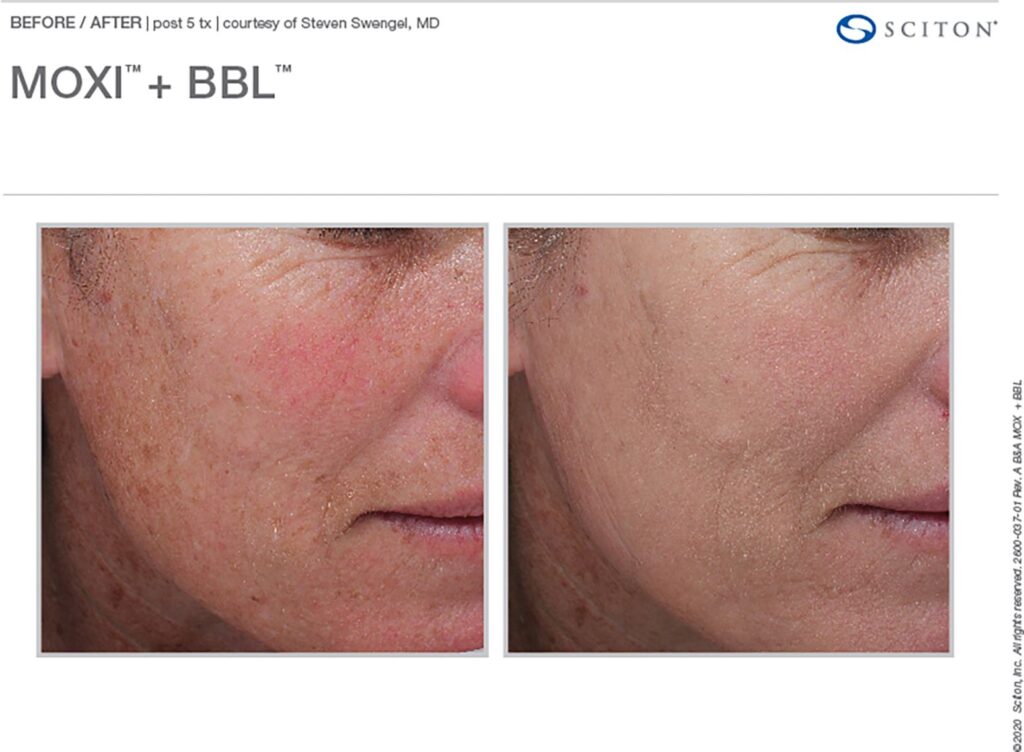 Moxi® Laser for Los Gatos, San Jose, Campbell & Saratoga, CA - RefinedMD